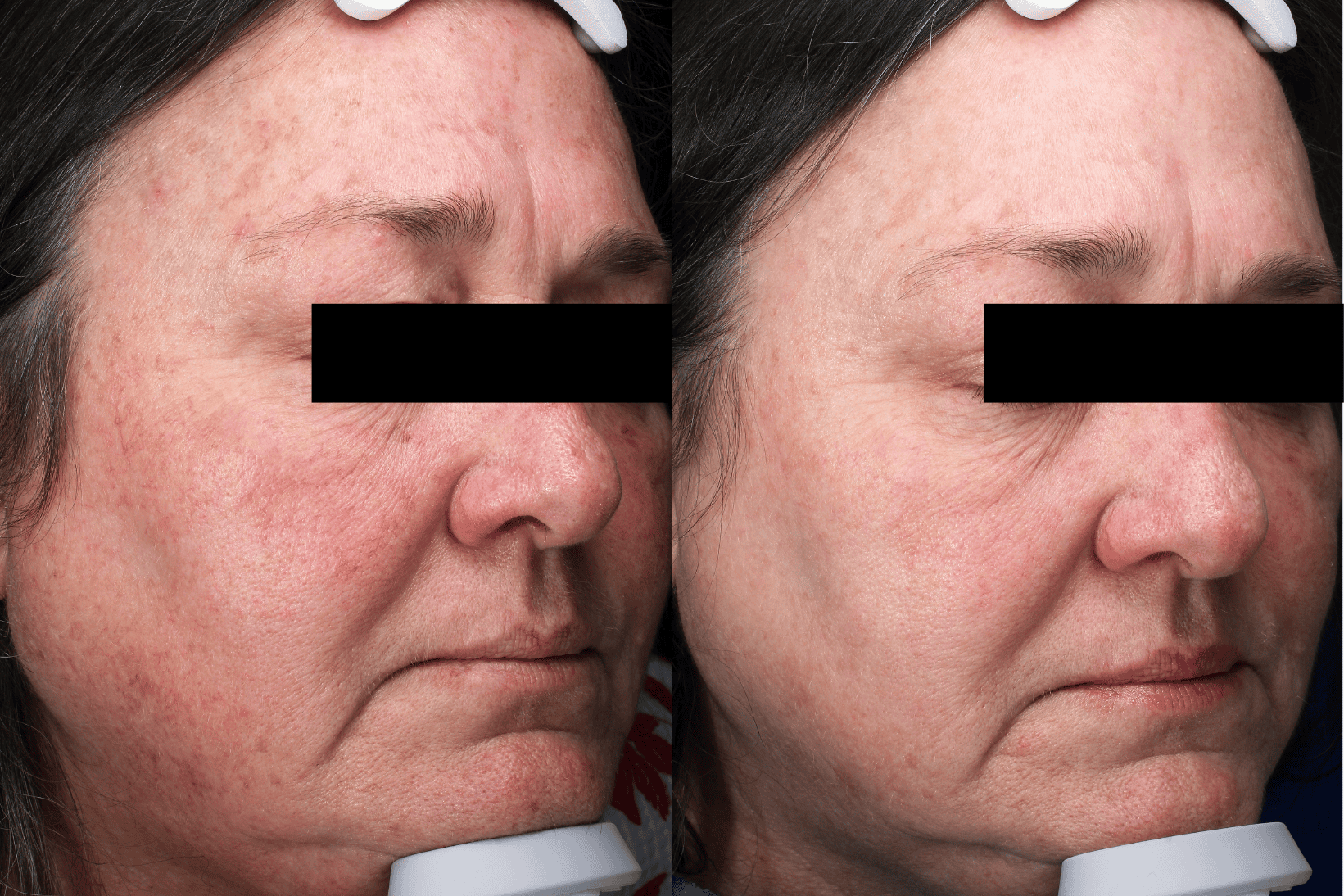 IPL 1 - Ducharme Dermatology